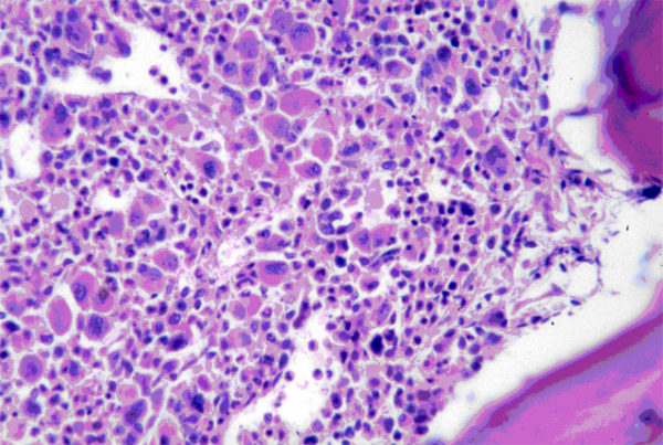 Células madre de médula ósea como tratamiento en EPOC y fibrosis ...